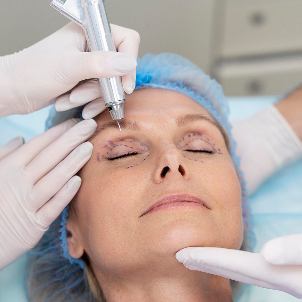 Plasma Eye Lift - Dermagénesis Costa Rica
